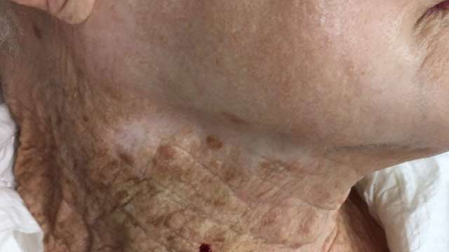 Woman Uses SPF On Her Face And Not On Neck Photo Of Her Damaged Neck