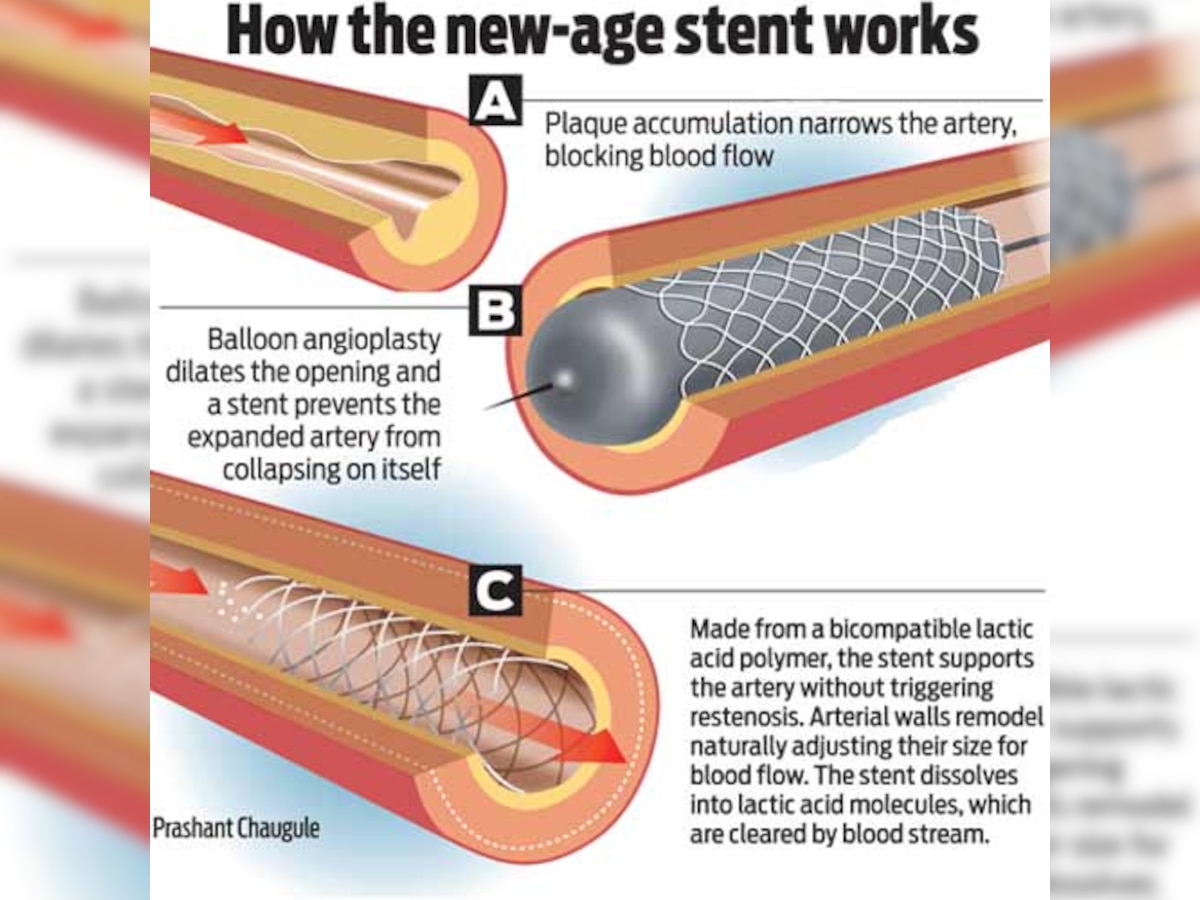 In a 'first', Ghatkopar resident gets seven absorable stents
