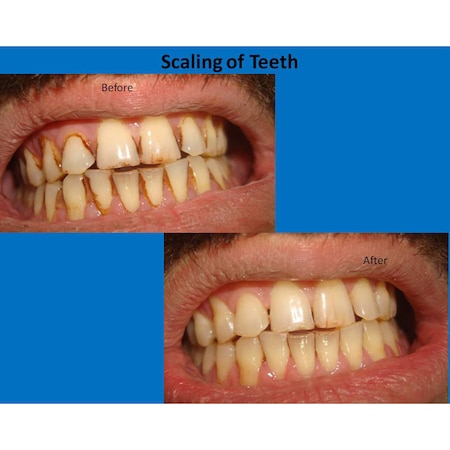 Everything you need to know about teeth scaling