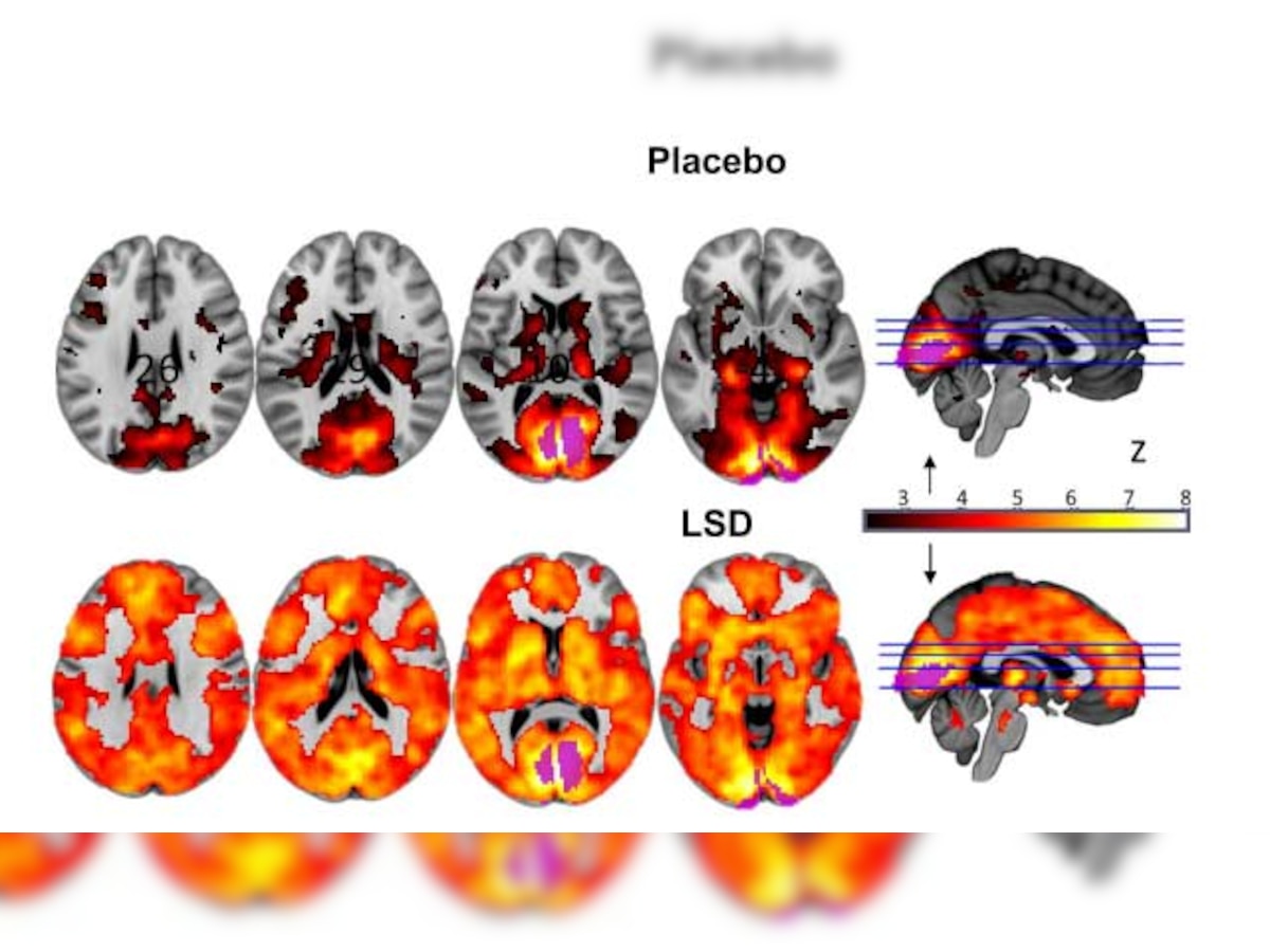 Brain scans show how LSD mimics mind of a baby