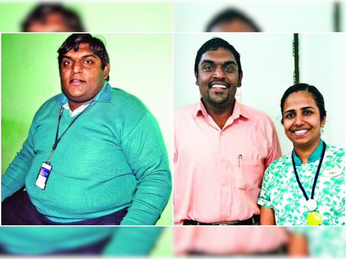 Gurugram nurse undergoes sleeve gastrectomy, loses nearly 50 kg