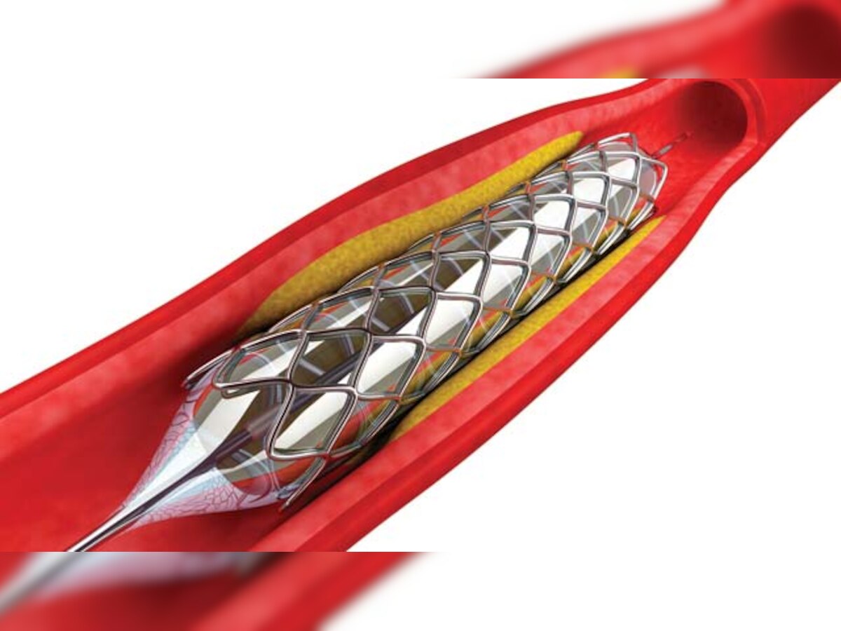 Pharma authority rejects MNC plea to withdraw stents from market