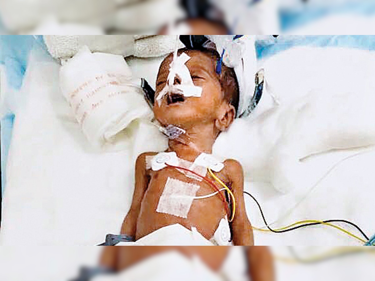 900-gram baby discharged after heart closure operation in Mumbai