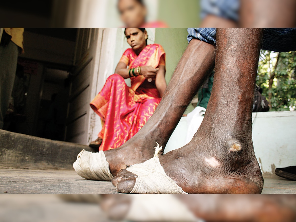 BMC health department staff finds 23 leprosy cases across Mumbai