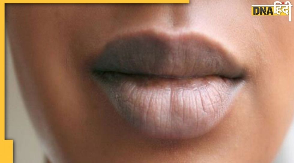 Dark Lips Signs: काले हो रहे होंठ तो इन 5 चीजों का है ये साइड इफेक्‍ट