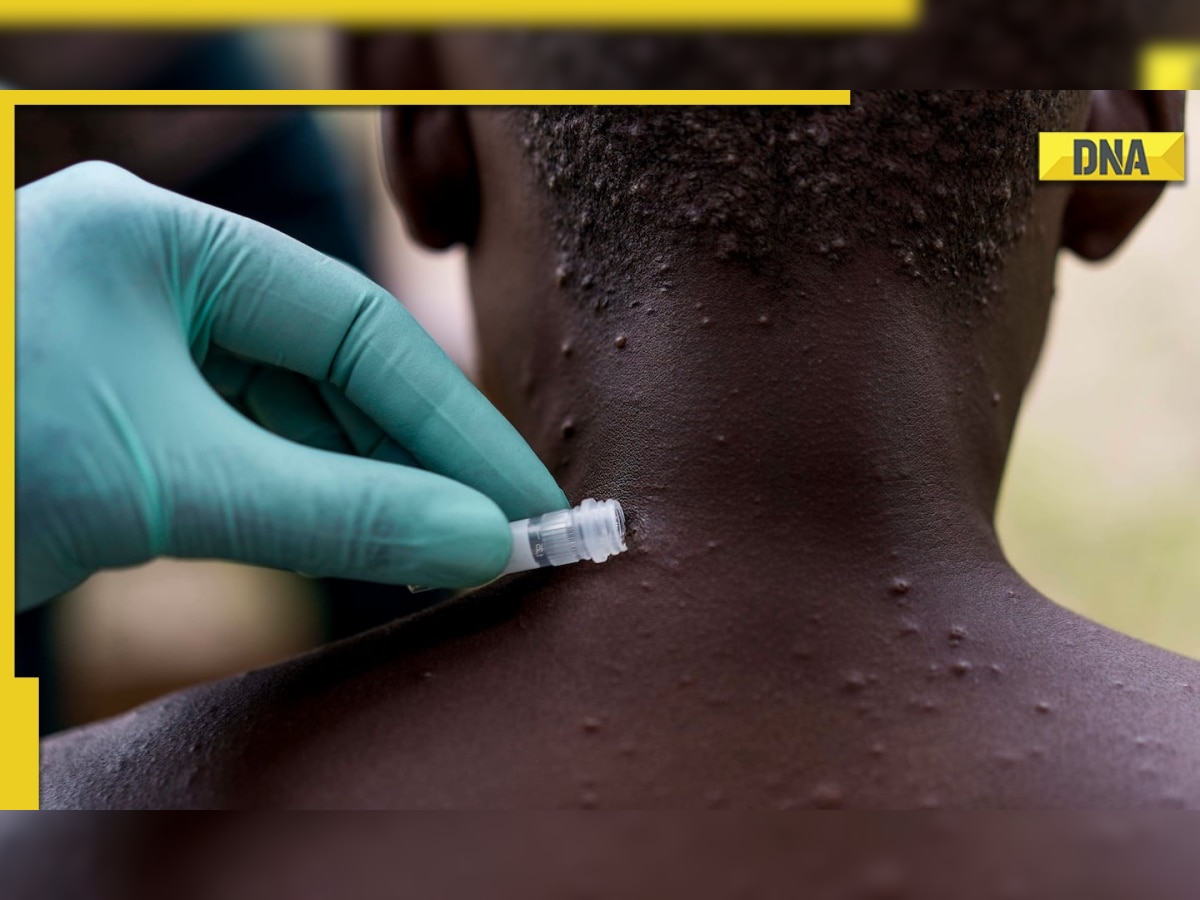 Monkeypox Scare: Delhi on alert after India reports its first-ever case ...