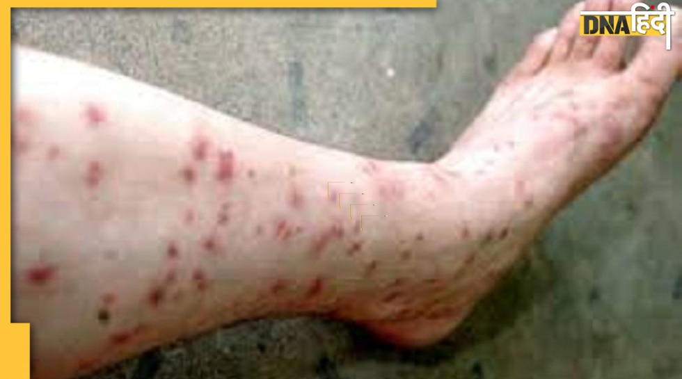 Black Fever: कालाजार ने फिर से दी दस्तक, आखिर कैसे एक मक्खी से फैलती है ...