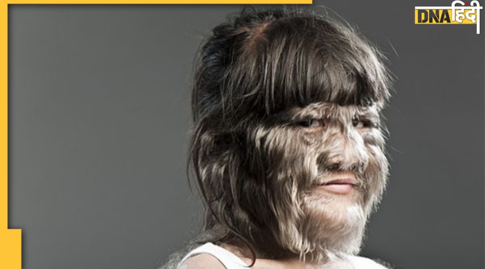 Werewolf Syndrome: एक अनोखी बीमारी जिसमें चेहरा बन जाता है भालू जैसा ...