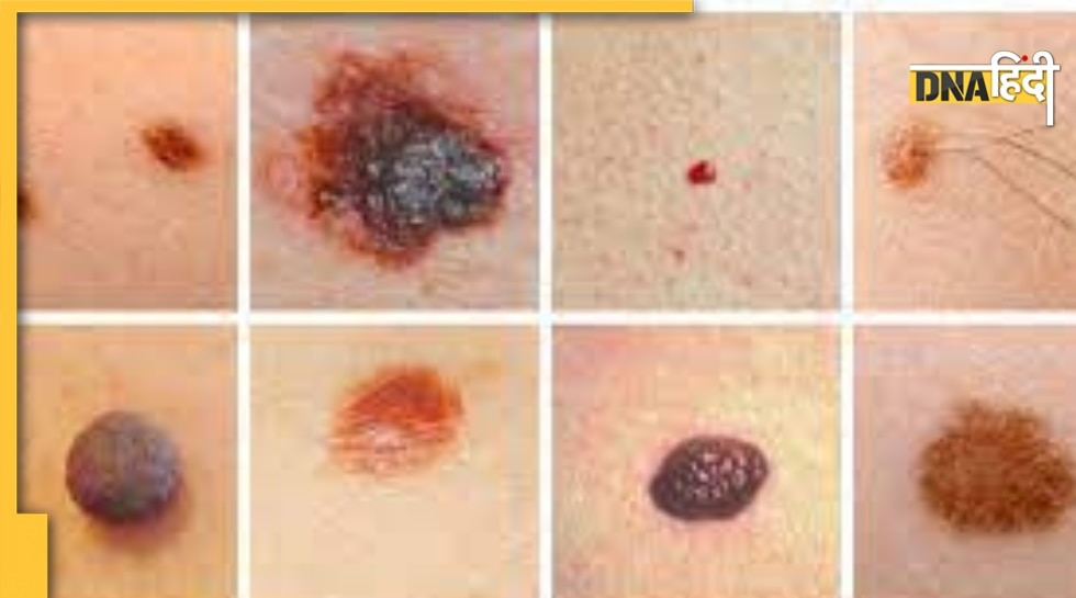 Skin Cancer: अगर त्वचा में बढ़ रहा है तिल का आकार तो हो जाएं सावधान, घर ...