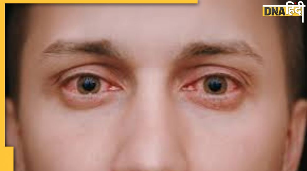 Pollution Dangerous Sign in Eyes: आंखों में जलन और खुजली के साथ आंसू दे ...