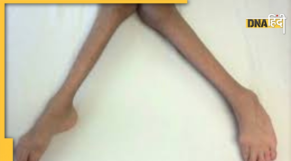 Rickets Disease in Kids: क्या है बच्चों में होने वाला सूखा रोग, कैसे ...