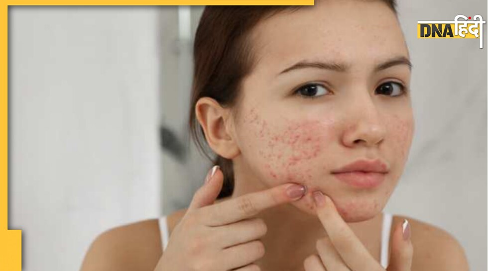 Dark Spot Causes: इन आदतों की वजह से चेहरे पर बढ़ते हैं दाग-धब्बे, आज ...