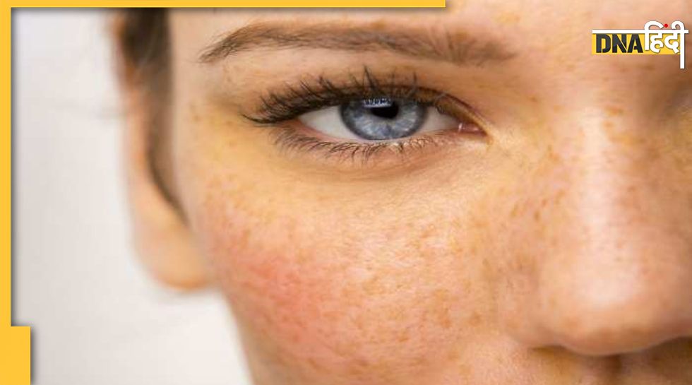 Pigmentation: चेहरे पर बनती झाइयां कहीं आपकी इस आदत से तो नहीं, समय से पहले बन जाएंगे बूढ़े