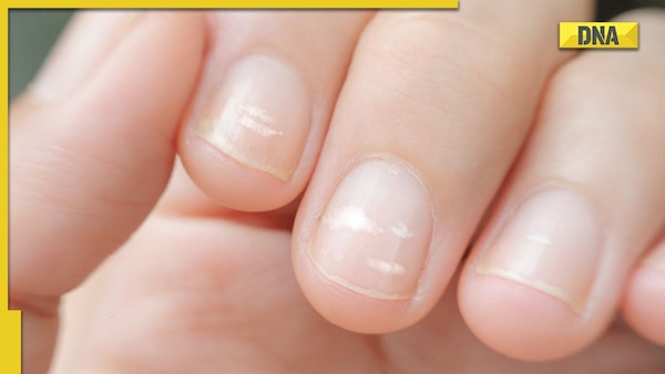 Are those white spots on your fingernails signs of calcium deficiency?