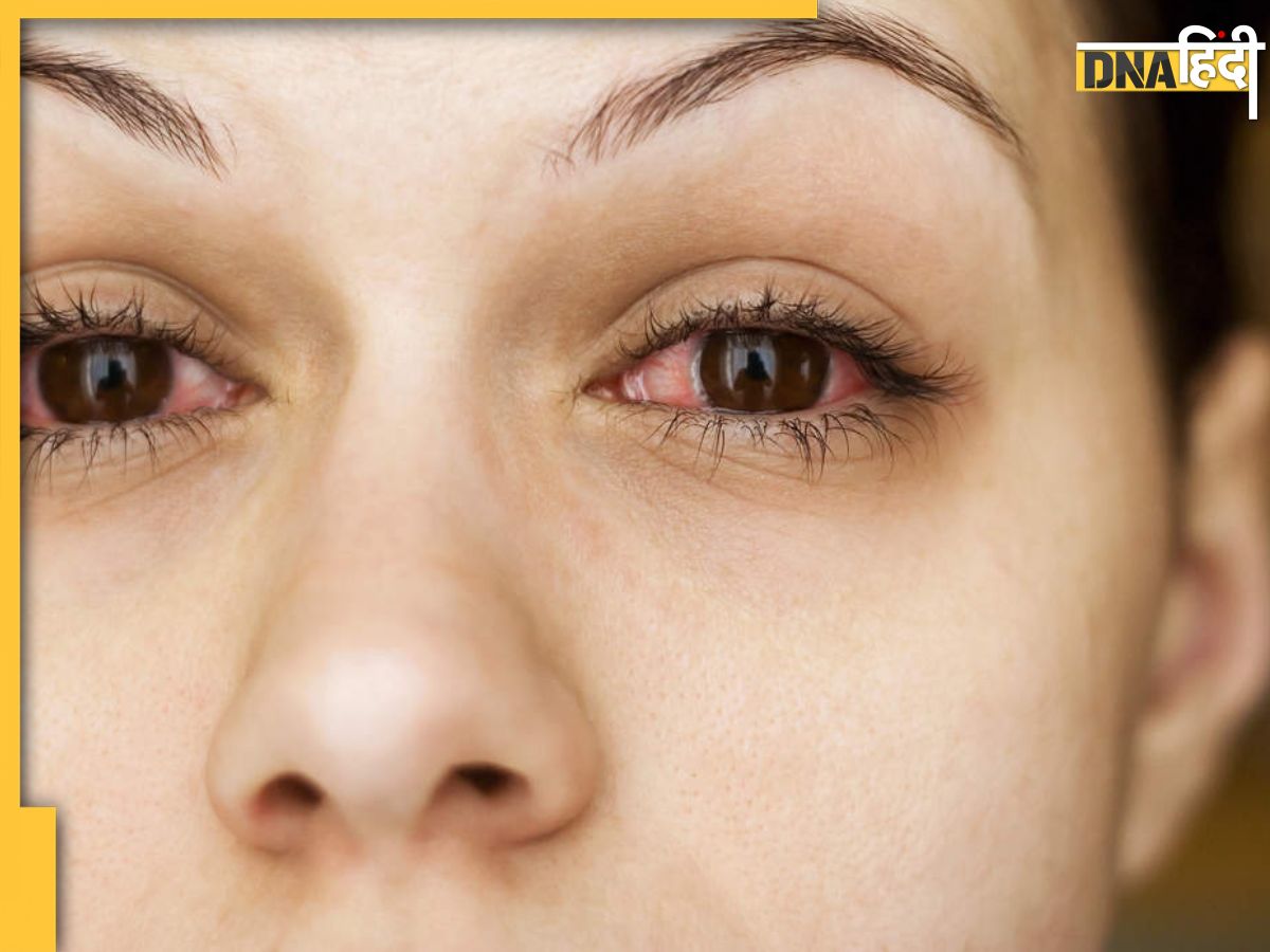 Eyes TB Signs: आंखों में तेजी से बढ़ रहा TB, धुंधलापन से लेकर लाल होने ...