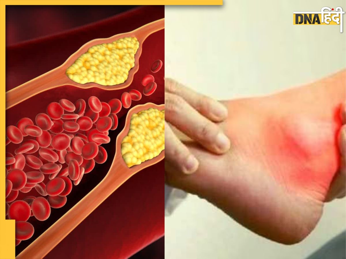 Cholesterol And Uric Acid कोलेस्ट्रॉल और यूरिक एसिड को एक साथ कंट्रोल कर देंगी ये पांच चीजें