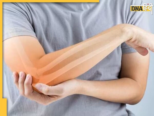Bone Disease Causes: कम उम्र में हड्डियों को खोखला कर देती हैं ये चीजें ...