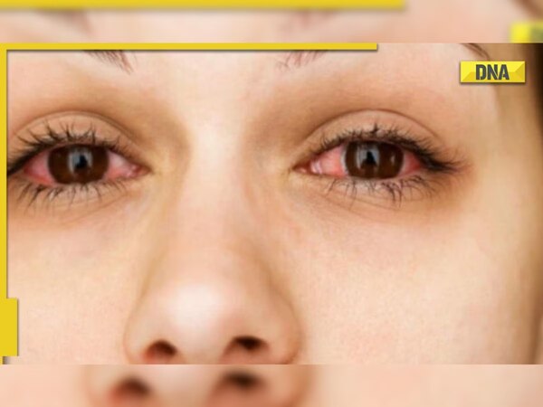 Eye flu: How to identify which kind of conjunctivitis you have? Know ...