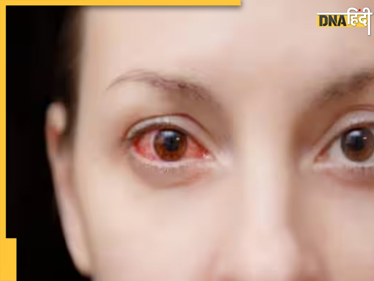 मानसून में बढ़ रहा है Eye Flu का खतरा, ट्रैवलिंग के दौरान फॉलो करें ये ...