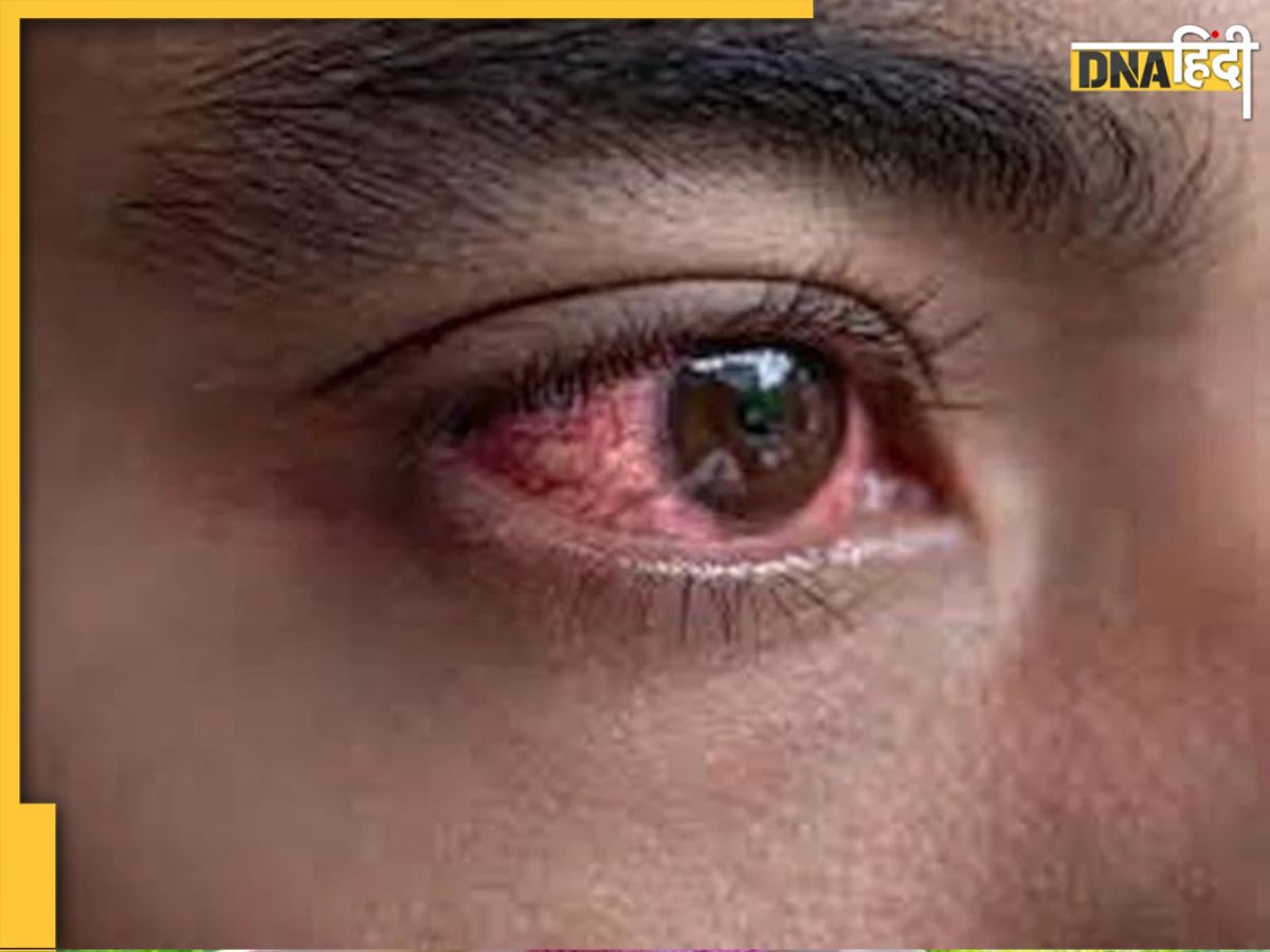 Eye Flu Treatment: सिर्फ 24 घंटे में ठीक सकता है आई फ्लू, इन 2 तरीकों ...