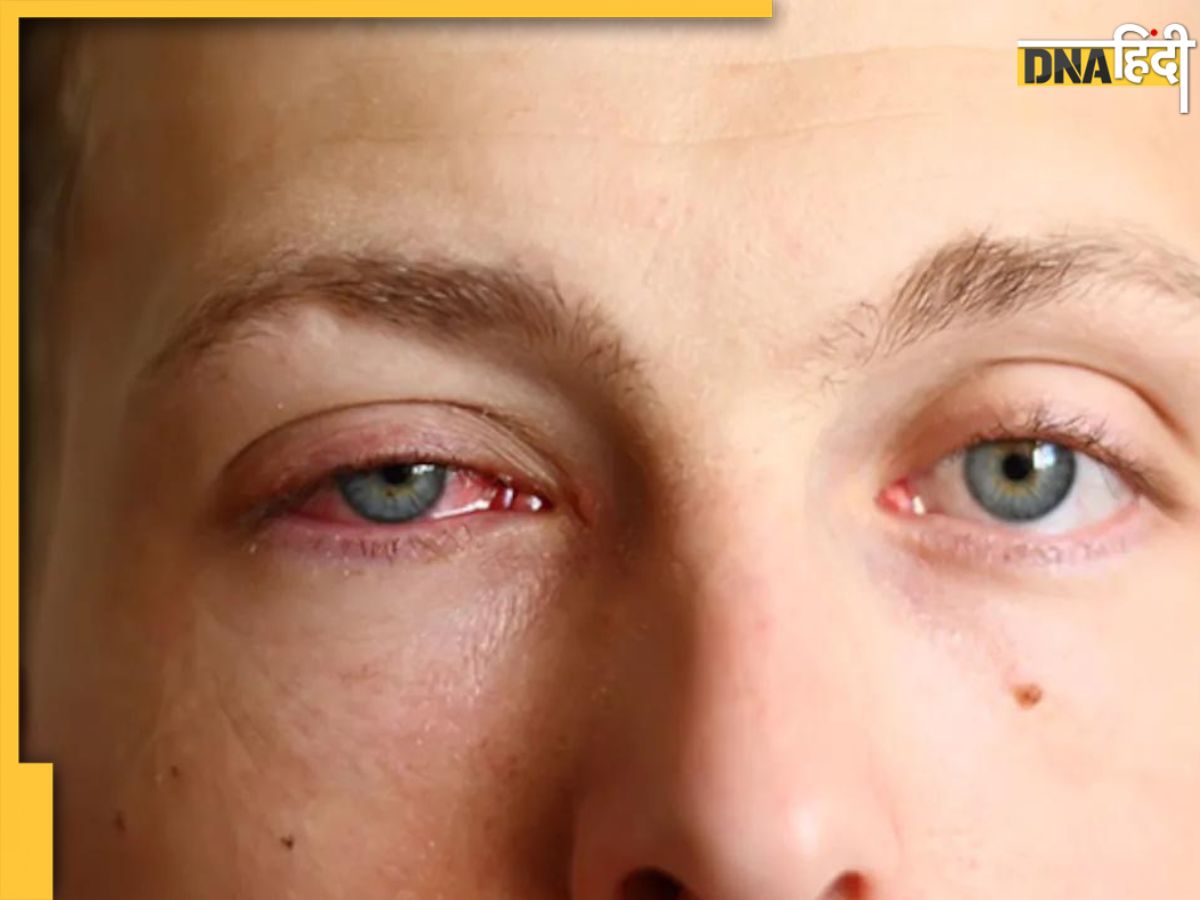 Eye Flu Diet Remedy: आई फ्लू में जरूर खाए ये 6 चीजें, जल्दी दूर होगा ...