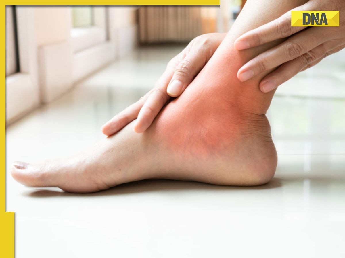 What is gout? Here's what you need to know about this painful ...