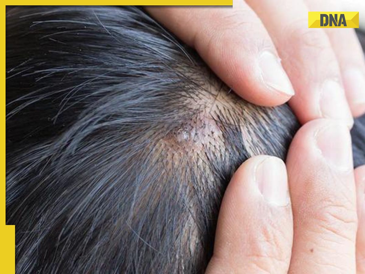 Pimples in hair store