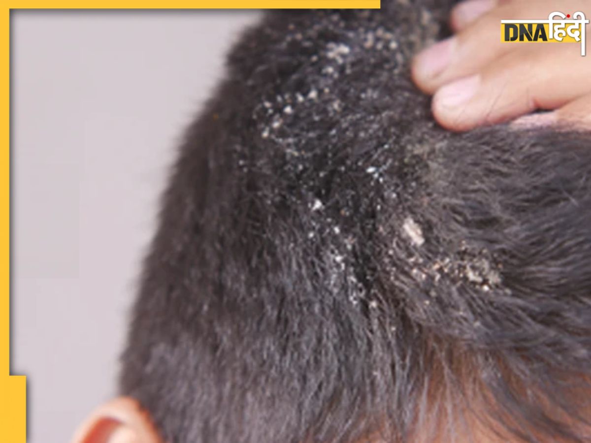 Dandruff Remedies: बालों की रूसी ने कर रखा है परेशान? इस रामबाण नुस्खे ...
