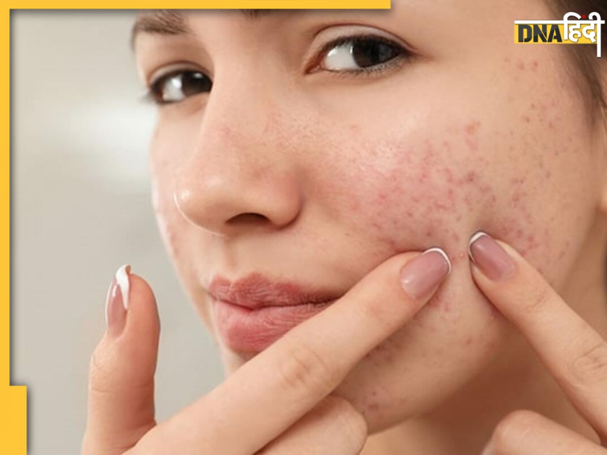 Pimples Remedies: खूबसूरती को खराब कर रहे हैं चेहरे के छोटे-छोटे दाने ...