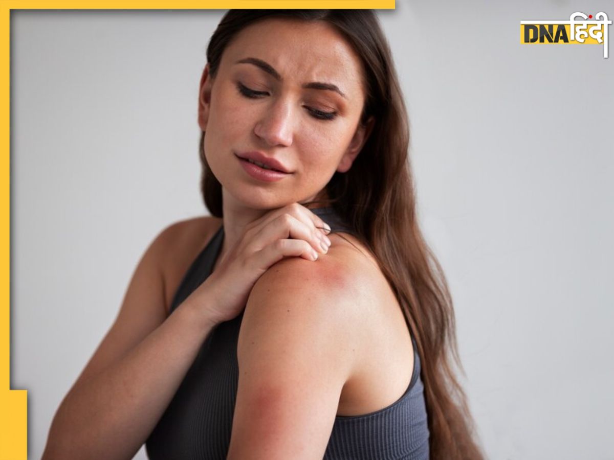 Heat Rash Remedy: गर्मी में घमौरियों से होने लगी है भयंकर खुजली और जलन ...