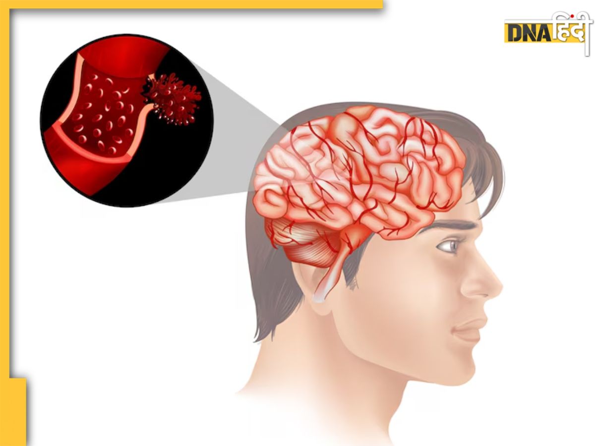 Brain Swelling: ये 5 लक्षण बताते हैं दिमाग की नसों में आ गई है सूजन ...
