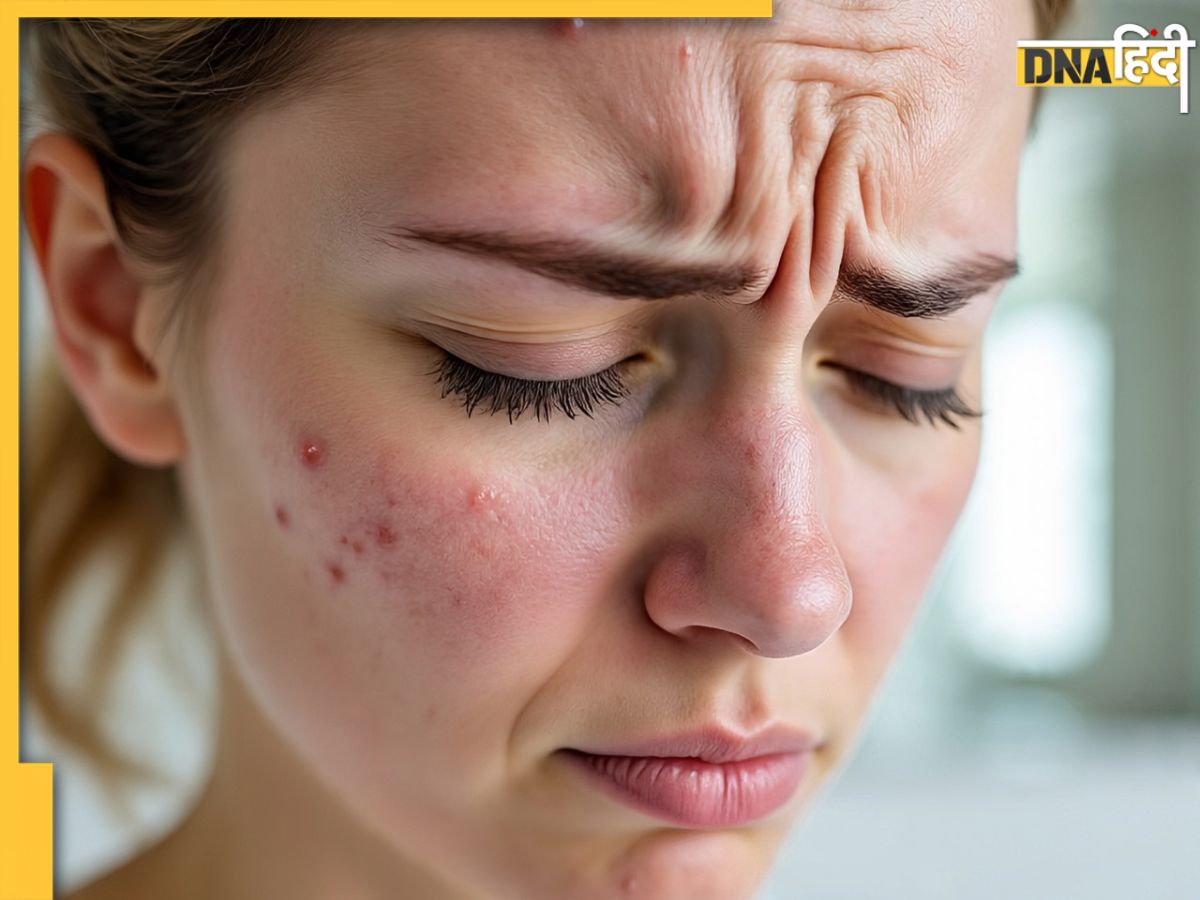 Pimples Remedies: कील-मुंहासों और छोटे-छोटे दानों को दूर करेंगे ये ...