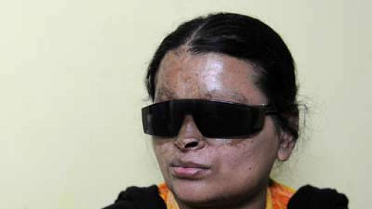Acid attack survivor gets job in Supreme Court, thanks to Judge