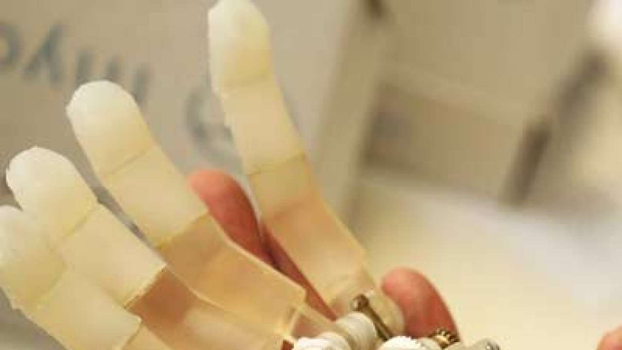 Bionic hand allows amputee to feel again
