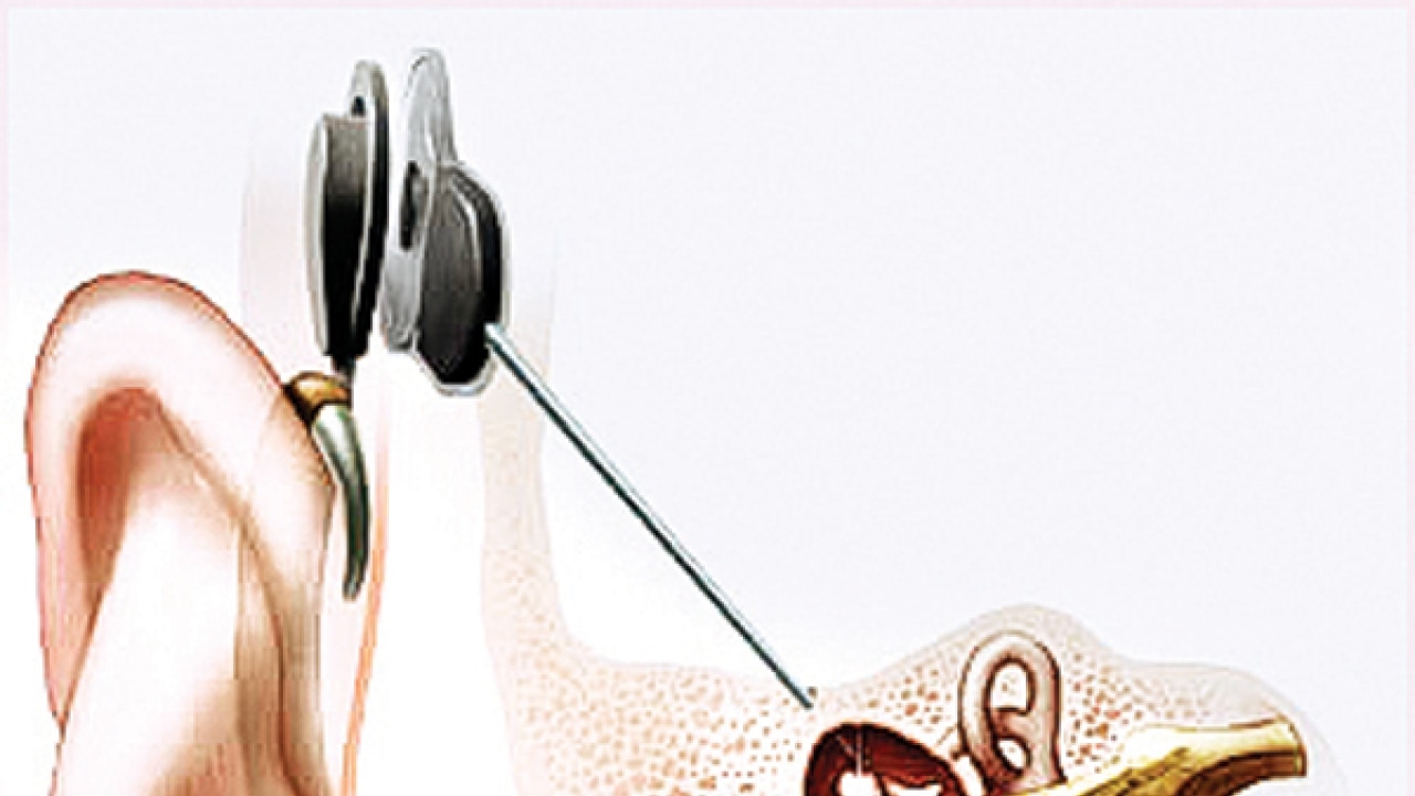 80-year-old gets a cochlear implant