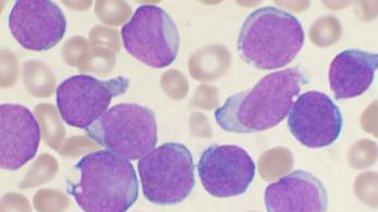 Living near highway may increase leukaemia risk in children: New study