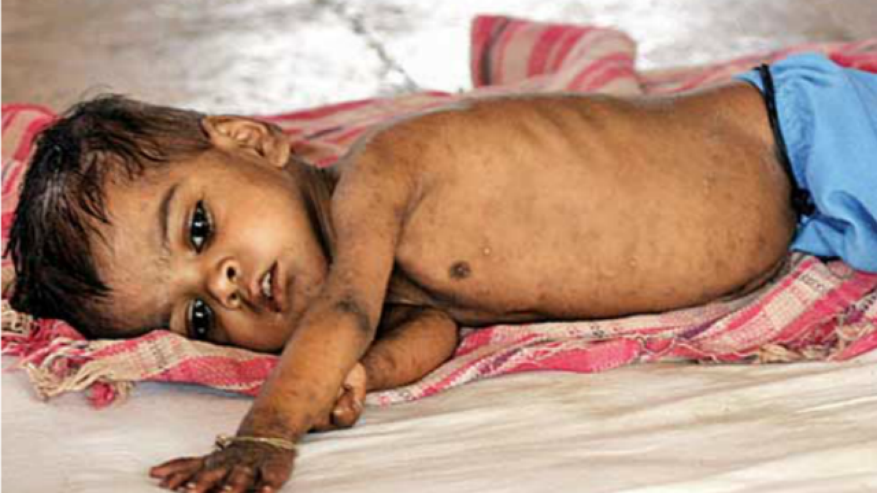 One in every two children in West Bengal anaemic: NFHS