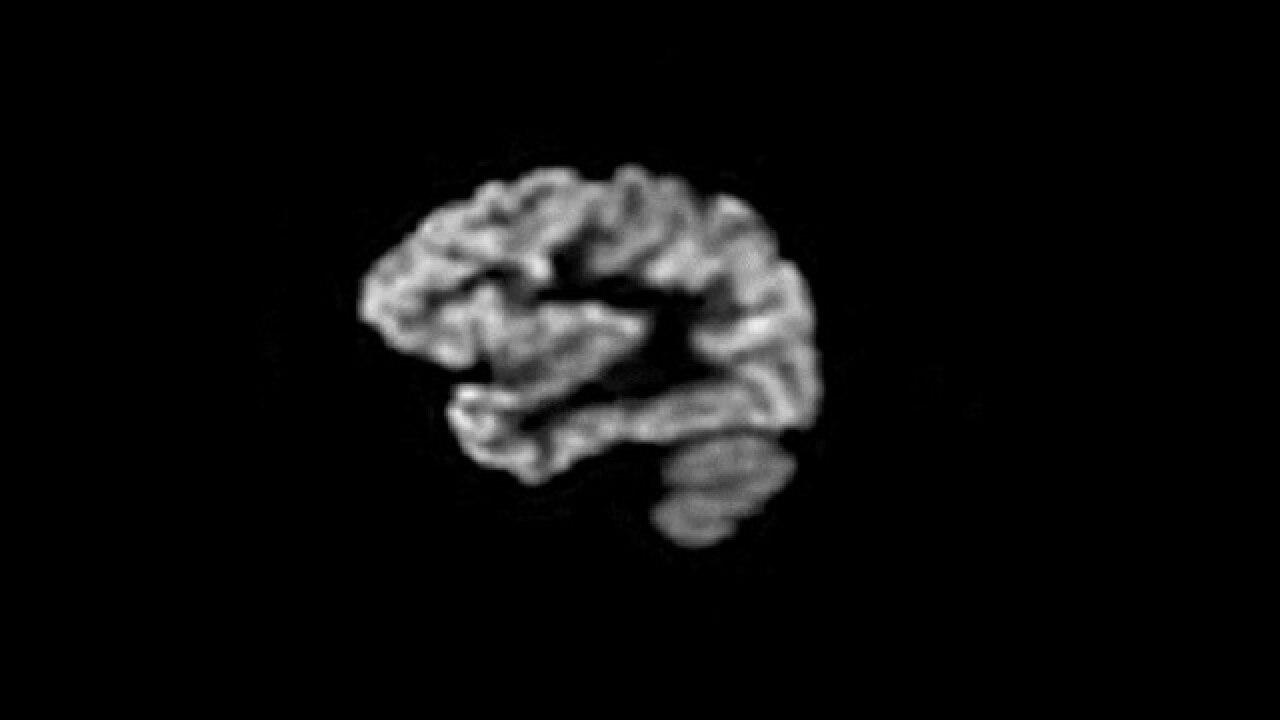 Scientists develop new imaging tool to scan brain for common disorders