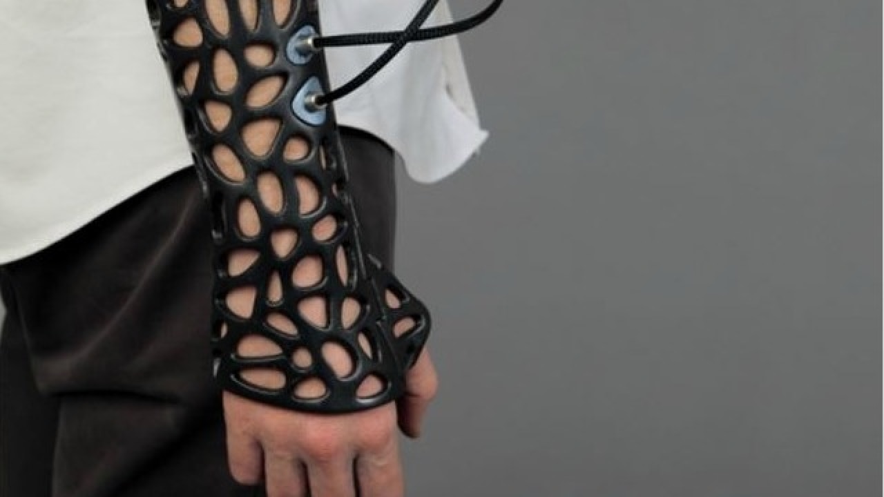 3D printed casts to treat fractures?