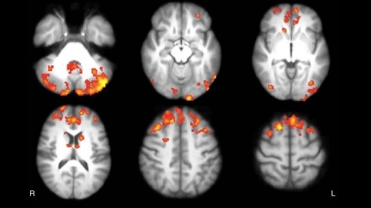 Research sets new target for brain cancer therapy