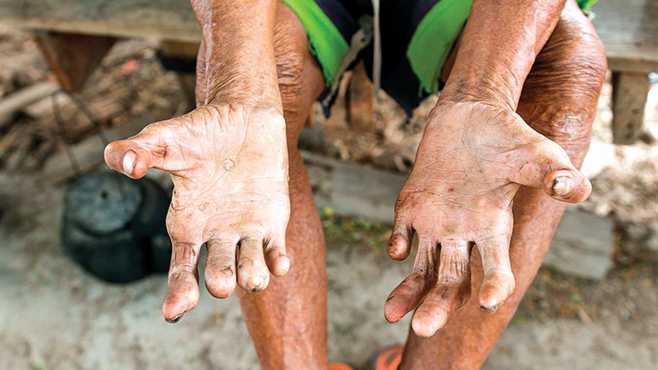 Mumbai to hold leprosy camps from September 24