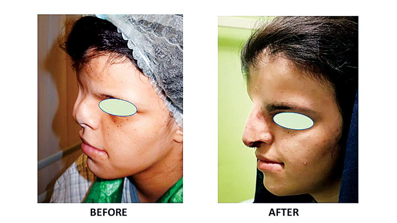 Iraqi girl with two noses undergoes a rare surgery in Delhi