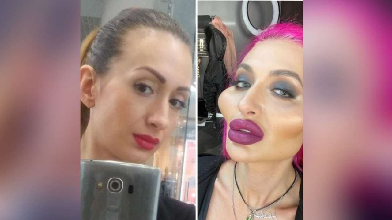 SHOCKING! Woman with ‘world’s biggest cheeks’ looked completely ...