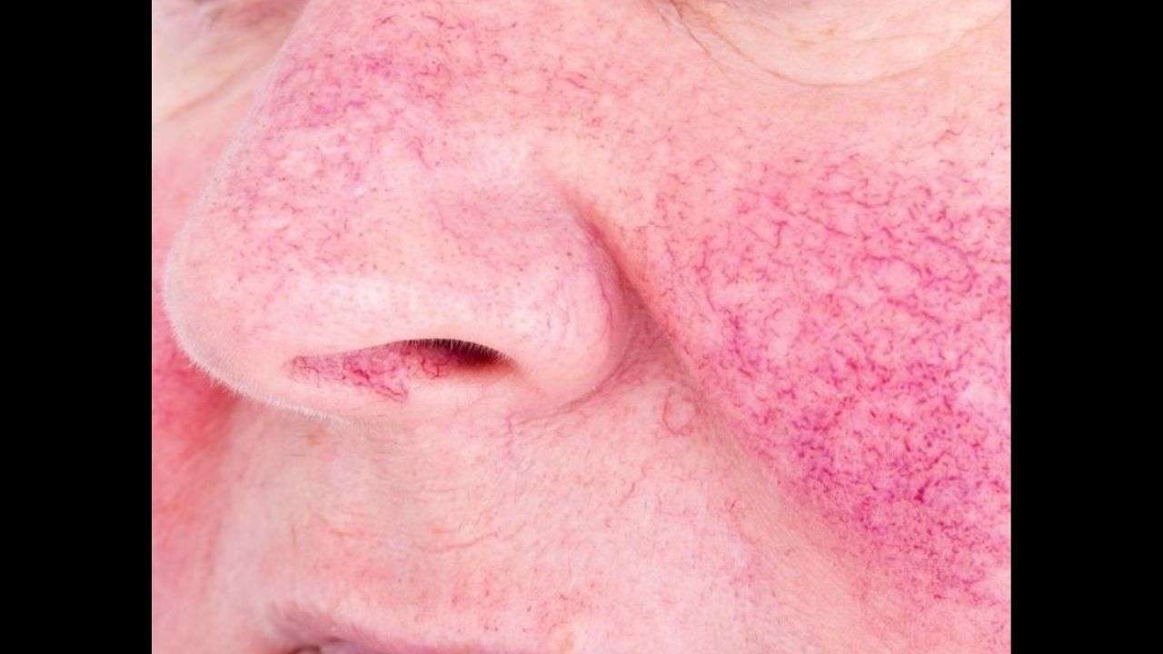 COVID-19: All you need to know about 'maskne', acne problems caused by ...