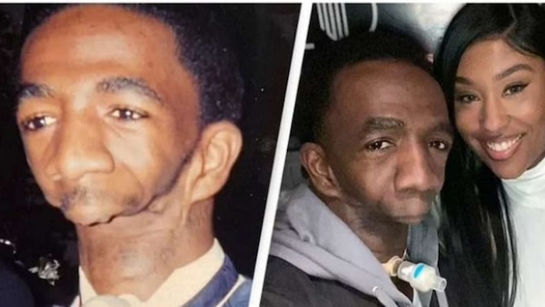 ‘I am a person with heart, feelings': Man born without jaw finds love ...