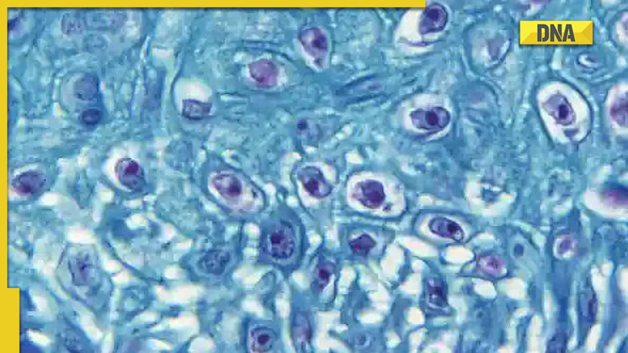 Monkeypox scare: More than 1,000 cases reported in non-endemic ...