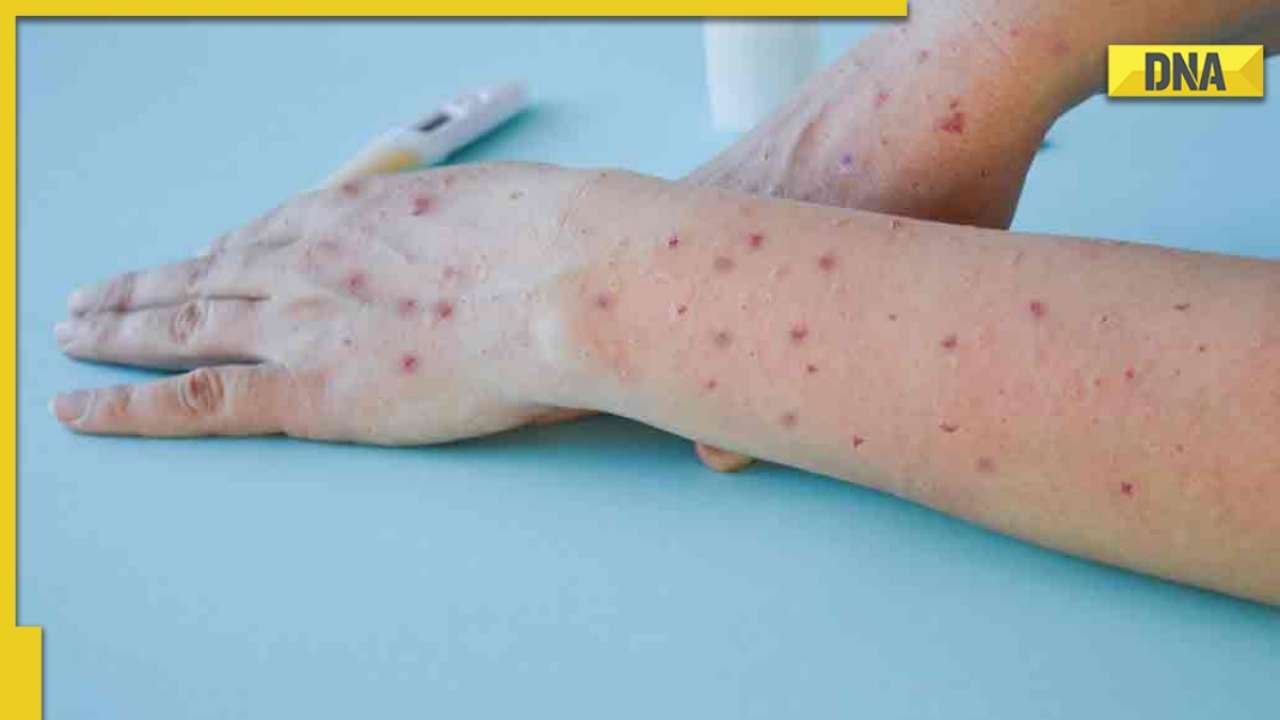 Tomato Fever spreads in Kerala: Know about symptoms, causes and ...