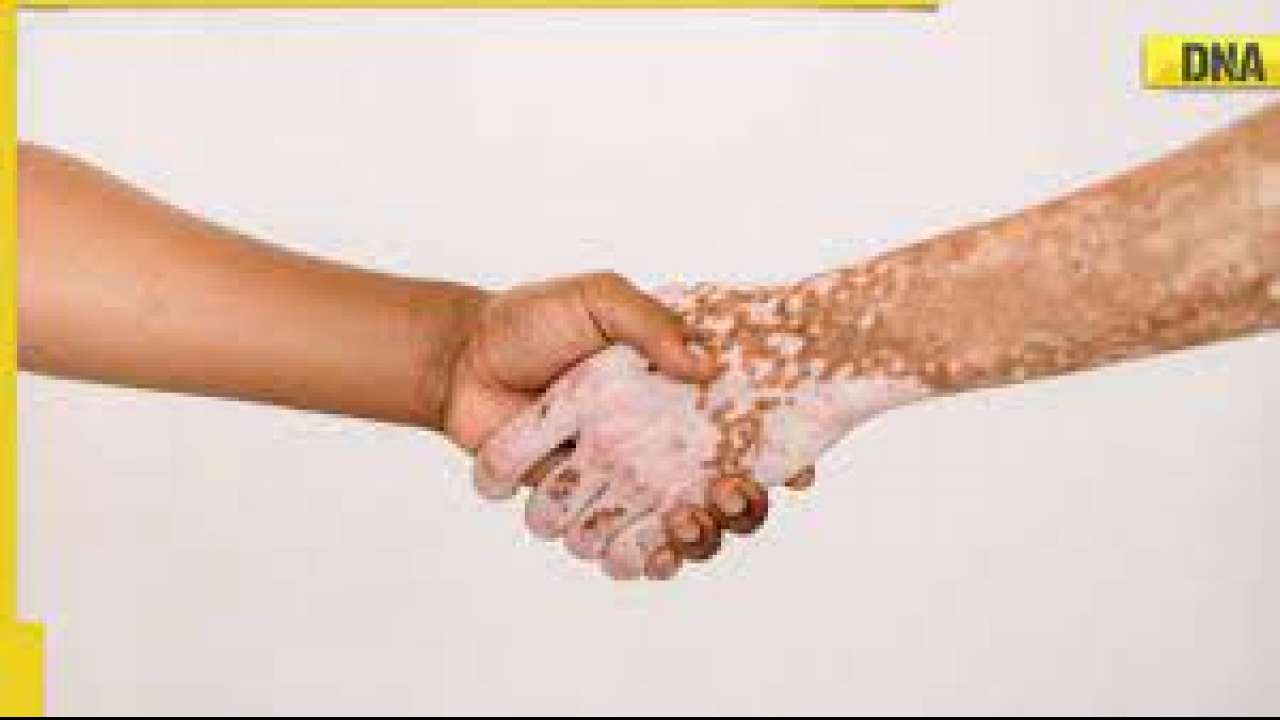 Vitilgo: Know about the disorder that can change the colour of your skin