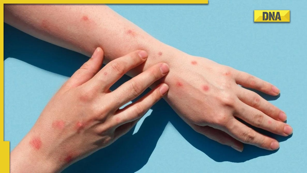 Monkeypox outbreak: Genetic mutation may be driving rapid spread of ...