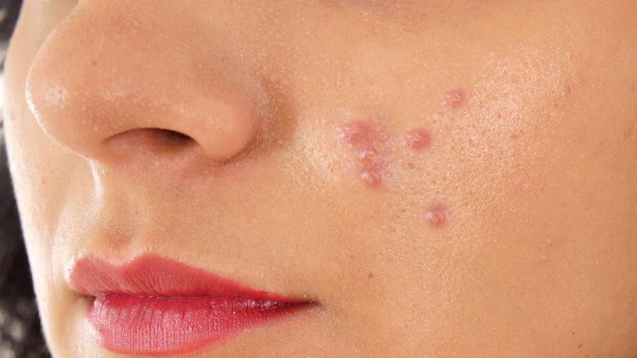 Skin problem: What are the 6 different types of acne?